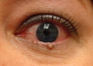 eyelid-wart1-343x243 - Costa Rica, Surgery, Doctor, Eye, Specialist ...