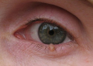 eyelid-wart4-343x243 - Costa Rica, Surgery, Doctor, Eye, Specialist ...